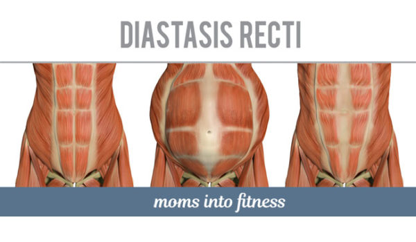 What Is Diastasis Rect Diastasis During Pregnancy